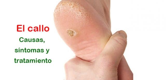 ¿Qué es el callo? Causas, síntomas, tratamiento y home remedies
