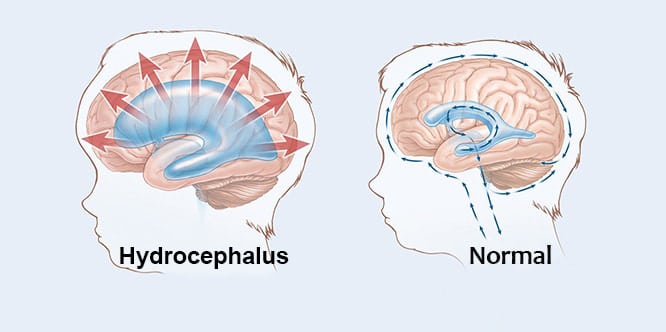 What is hydrocephalus? Causes, symptoms and treatment