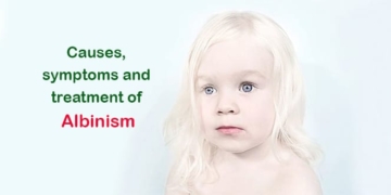 What is Albino? Causes, symptoms and treatment of Albinism