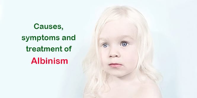 What is Albino? Causes, symptoms and treatment of Albinism