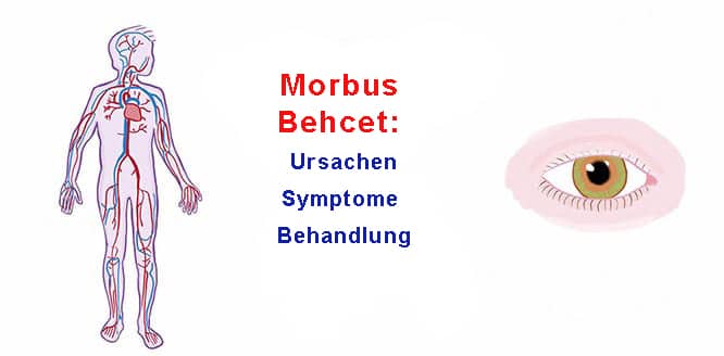 Morbus Behçet – Aktualisierte EULAR-Leitlinie für das Behçet-Syndrom ...