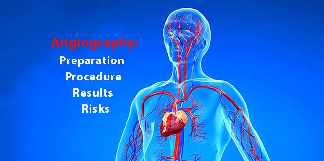 Angiography (Angiogram): Preparation, procedure, results and risks
