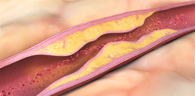 What is atherosclerosis? Causes, symptoms and treatments