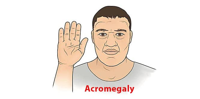 What is acromegaly? Causes, symptoms and treatment