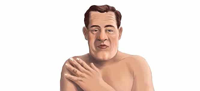 What is acromegaly? Causes, symptoms and treatment