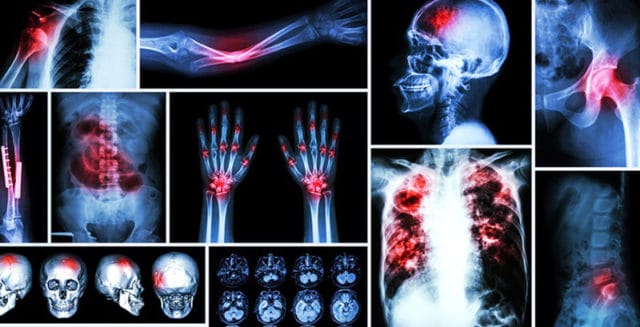 What causes bone cancer? Symptoms, stages and treatments