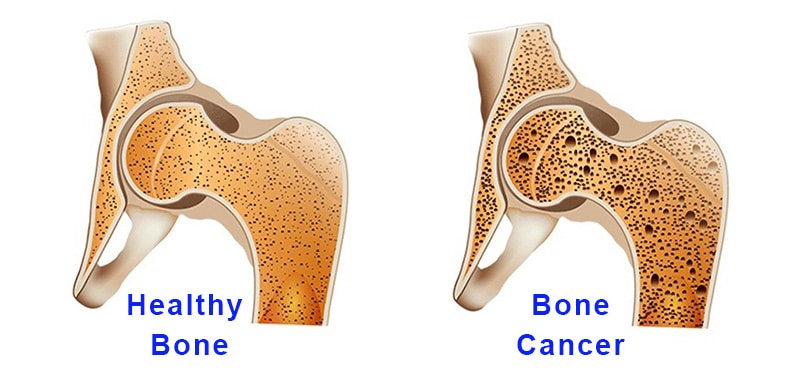 What causes bone cancer? Symptoms, stages and treatments