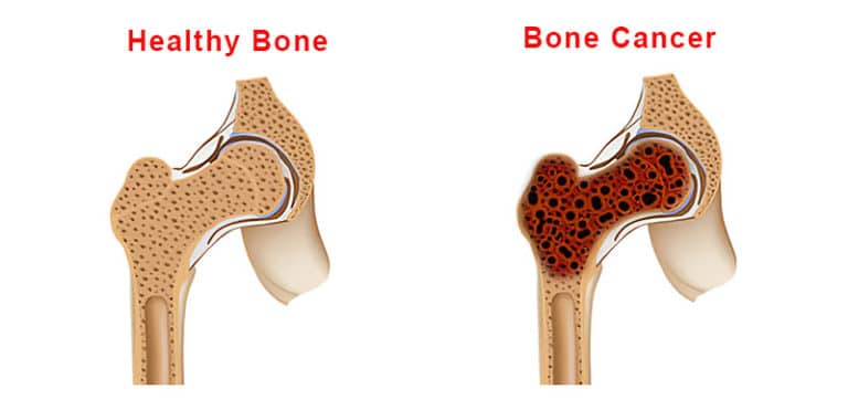 What causes bone cancer? Symptoms, stages and treatments