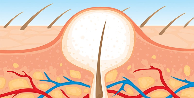 How to stop inflamed acne? Causes, Symptoms and Treatment