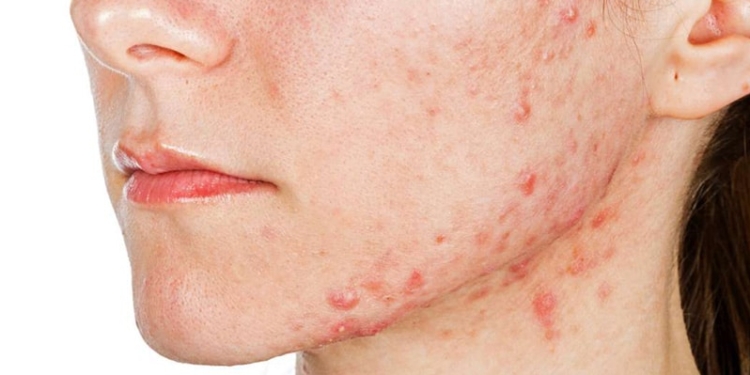 How to stop inflamed acne? Causes, Symptoms and Treatment